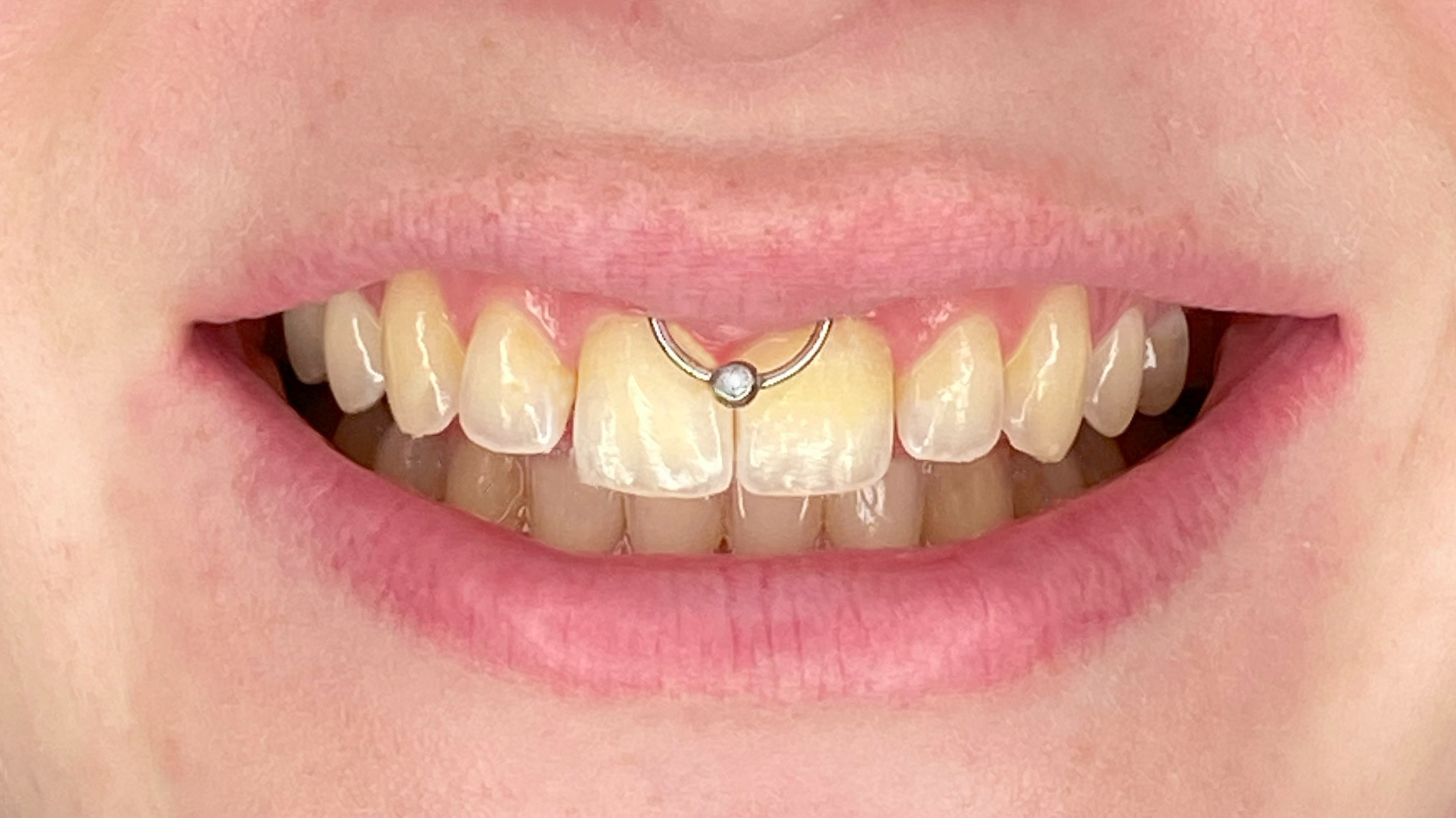 Piercing Smiley | Le Guide Complet